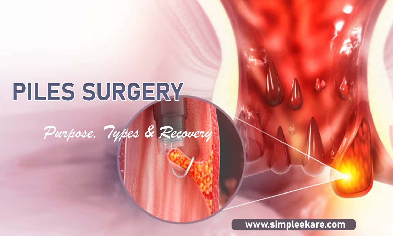 Surgical Treatment For Piles: Different Procedures And Recovery Process ...