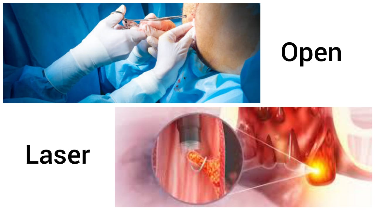 Laser vs. Open Surgery: Which is Better for Piles? - SimpleeKare ...