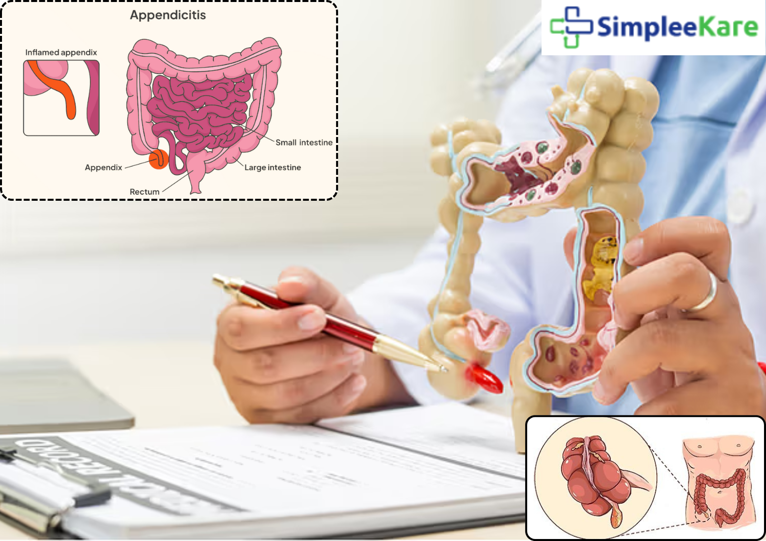 Appendicitis Surgery: Symptoms, Causes, Treatment & Surgery in India ...